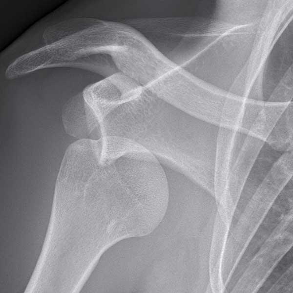 Axel ur led - operation och fysioterapi • Södermalms ortopedi