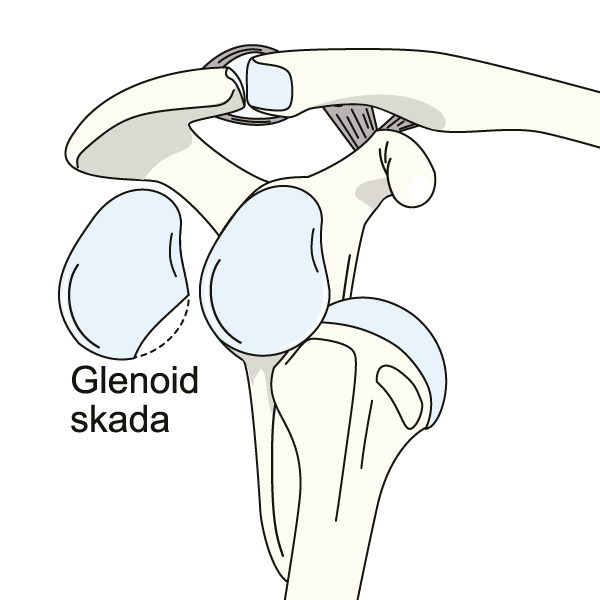 Axel ur led - operation och fysioterapi • Södermalms ortopedi