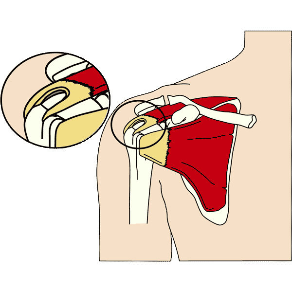 Rotatorcuffruptur efter ett fall på cykel? • Södermalms ortopedi